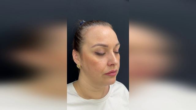 Два месяца после круговой блефаропластики с коррекцией малярных мешков