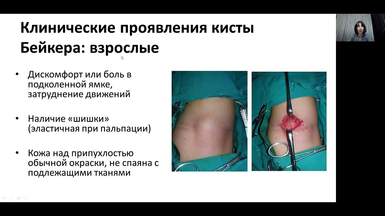 #УЗИ  заднего отдела коленного сустава. Киста Бейкера.