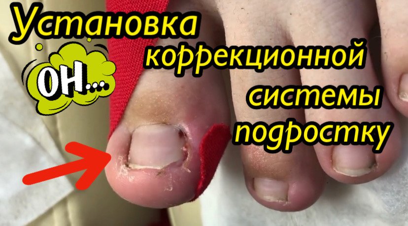 Установка коррекционной системы подростку??⚠️?❗️