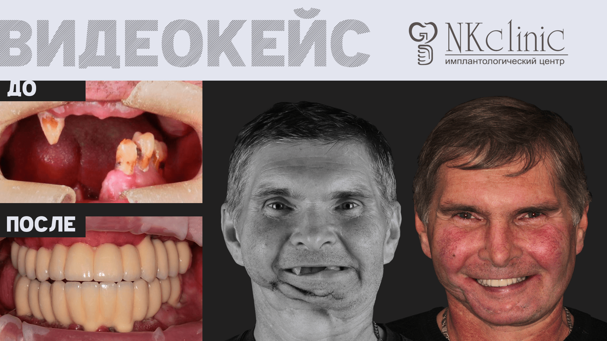 Реконструкция нижней челюсти