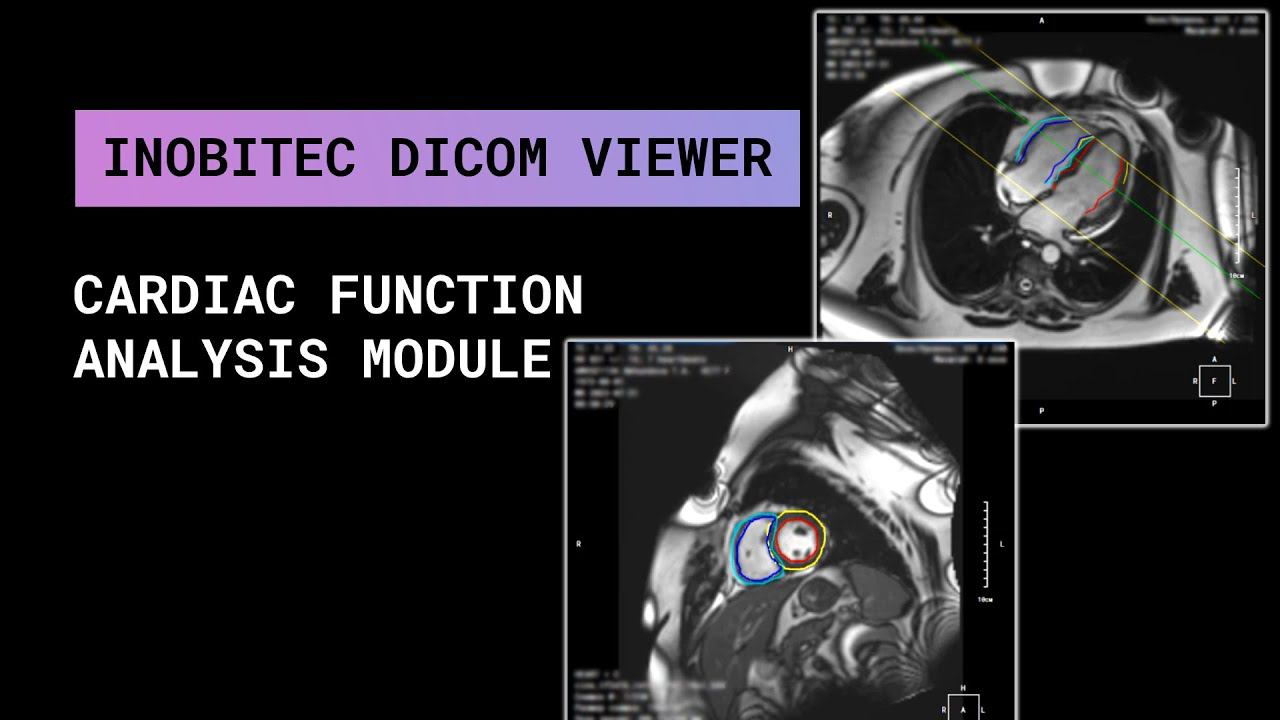 Дополнительный модуль функционального анализа сердца в Inobitec DICOM Viewer Pro