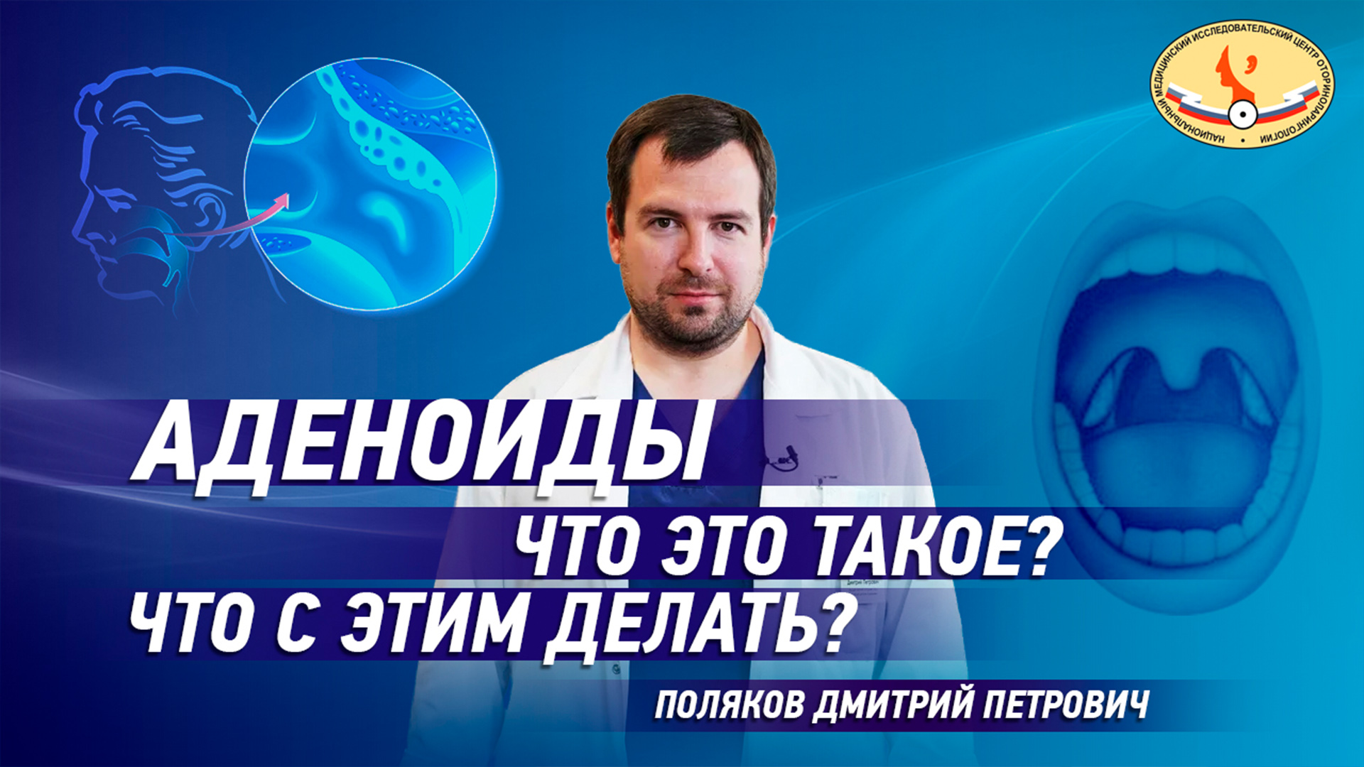 Аденоиды. Что это такое Что с этим делать Детская оториноларингология с Дмитрием Поляковым.