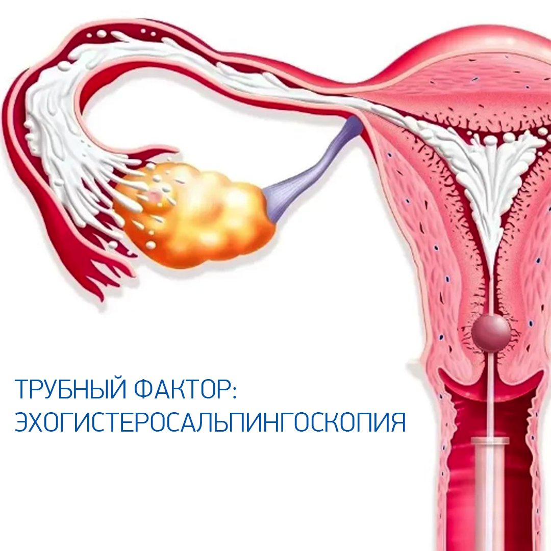 Трубный фактор в гинекологии . Рассказывает врач-гинеколог NEO-Clinic Андрей Бирюков
