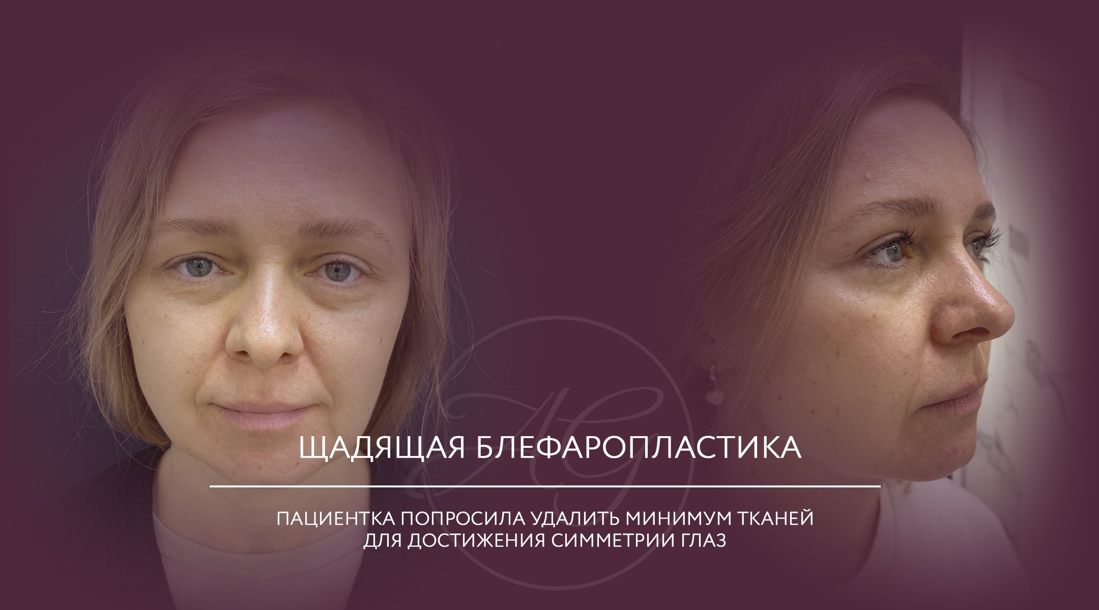 Верхняя блефаропластика с сохранением тканей