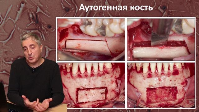 Направленная Костная Регенерация (НКР) Часть 2. Ауто-костные трансплантаты