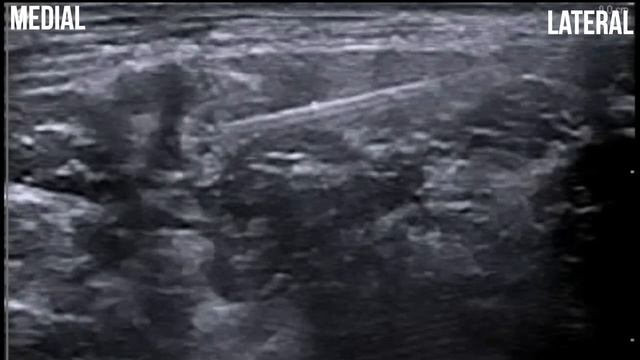 Межлестничная блокада плечевого сплетения