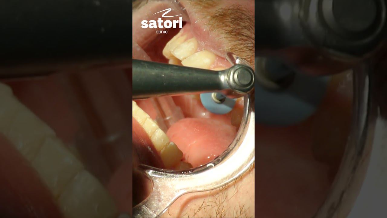 Снятие брекетов #брекеты #зубы #стоматологиясамара