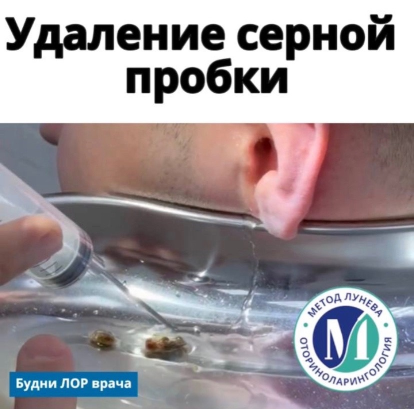 Удаление серной пробки из уха
