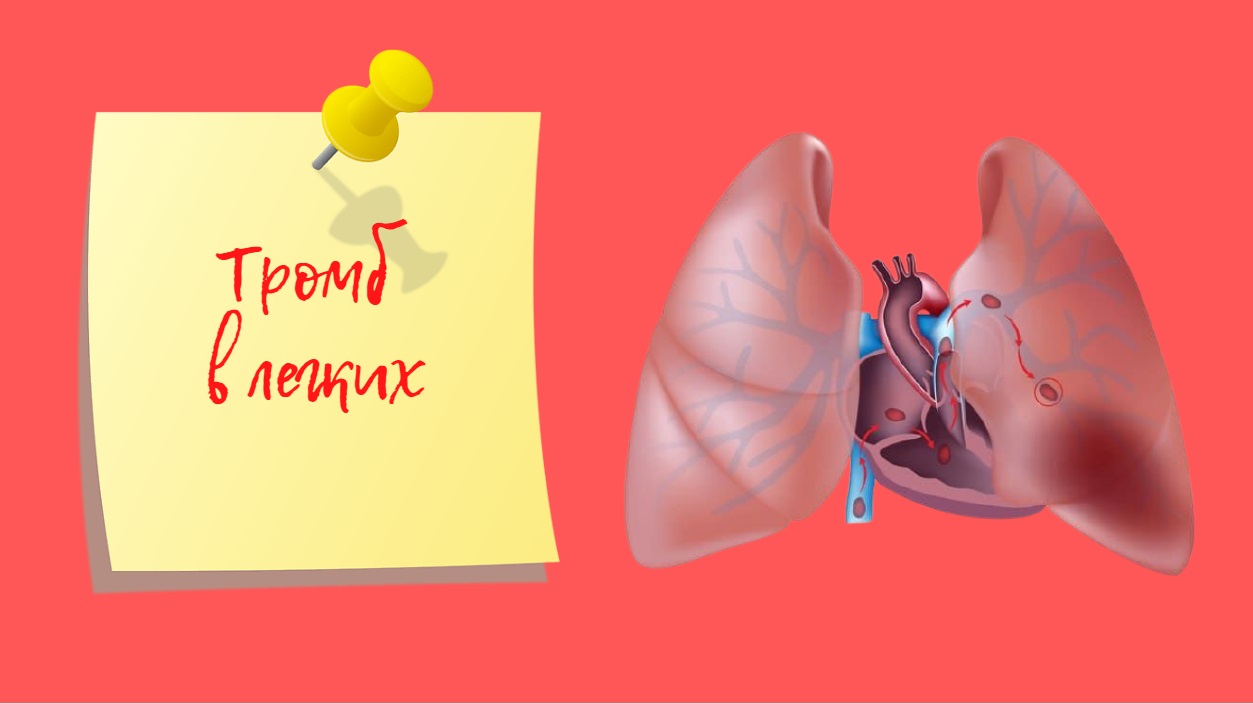 Тромб в легких | Нужны ли лекарства?