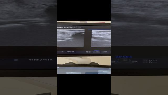 Случайная находка при обследовании сосудов. Щитовидная железа, узлы. Узи сосудов. Флеболог Москва