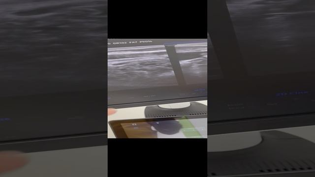 Тромбоз после лазерной операции. Лечение тромбоза. Лечение варикоза. Флеболог. Флеболог Москва