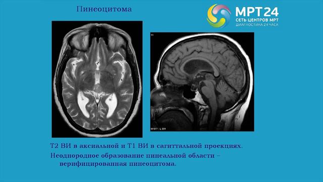 МР-визуализация патологий эндокринной системы