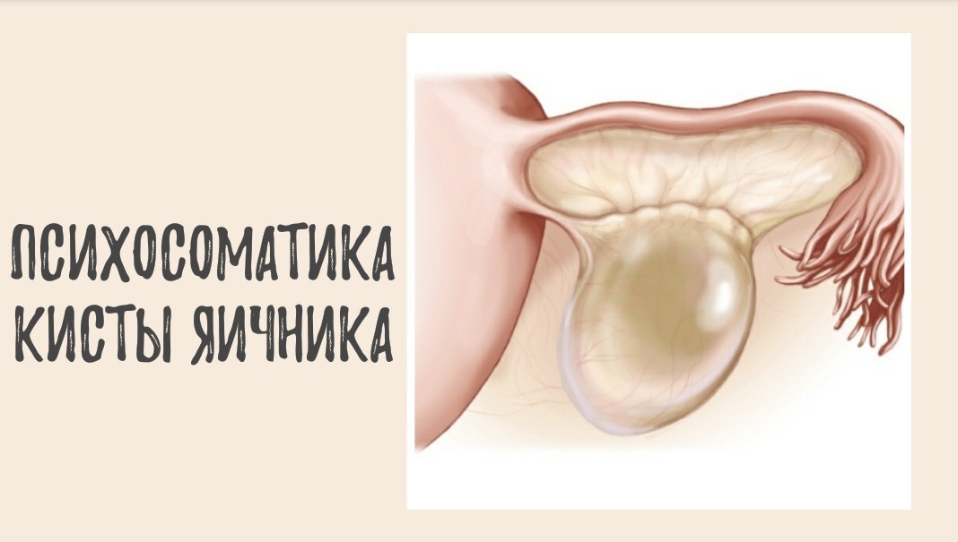 Психосоматика кисты яичника – киста яичника и ее настоящие причины.