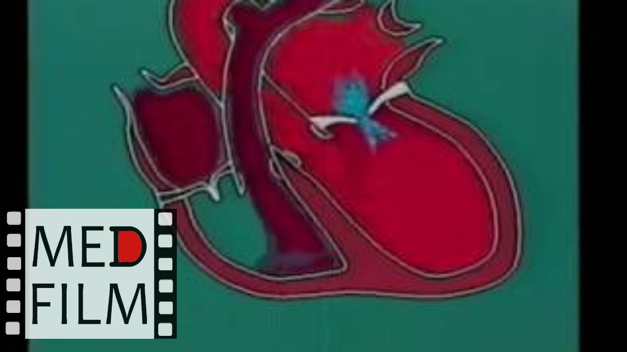 Митральная недостаточность. Эхокардиография ©Mitral insufficiency. Echocardiography