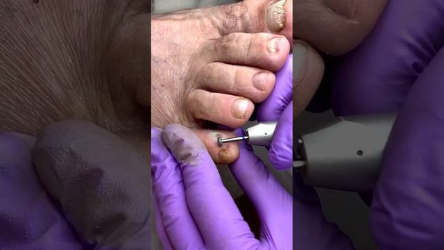 Мозоль на пальце ноги, удаление. Подолог Симферополь.