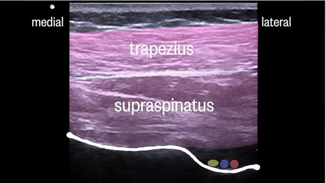 Блокада надлопаточного и подмышечного нервов