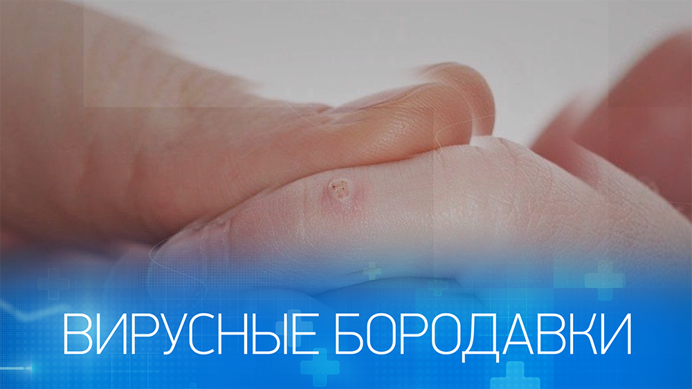 Вирусные бородавки
