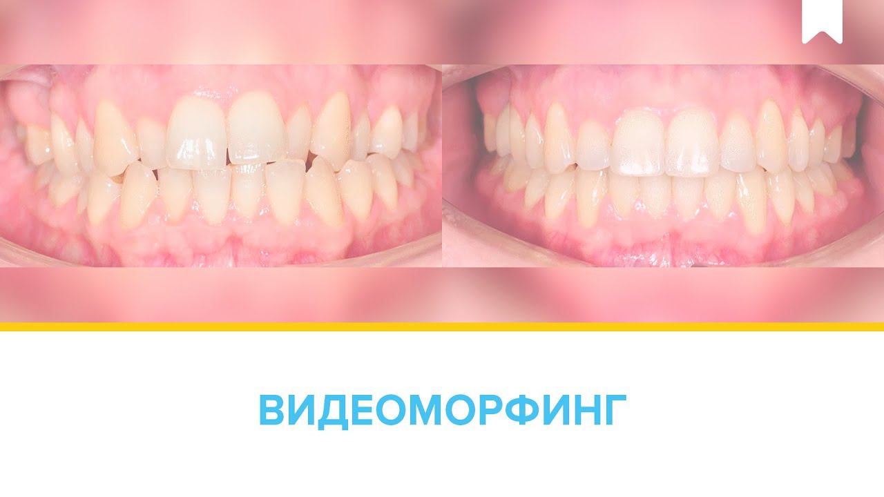 Результаты лечения брекетами пациентки в 36 лет за 22 месяца!