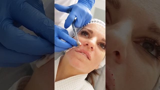 УВЕЛИЧЕНИЕ ГУБ, КОРРЕКЦИЯ ФОРМЫ И ОБЪЕМА ГУБ(1)