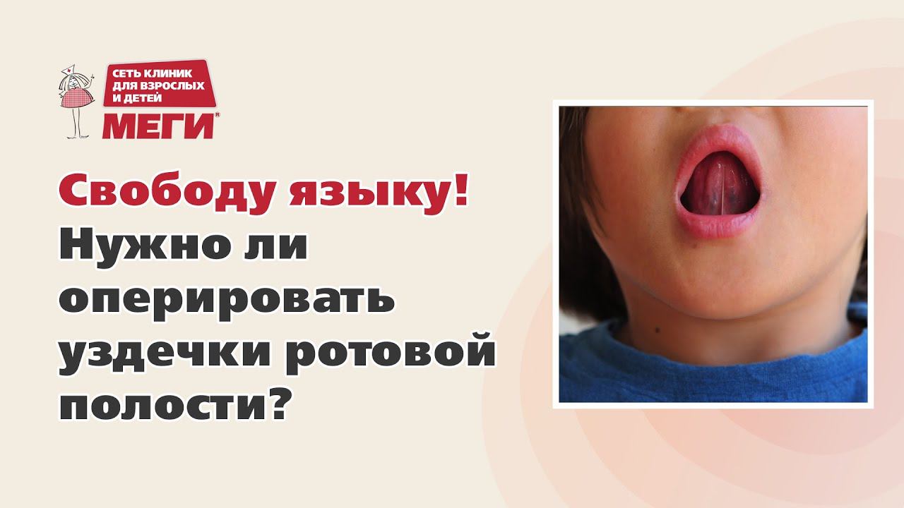 Свободу языку! Нужно ли оперировать уздечки ротовой полости?