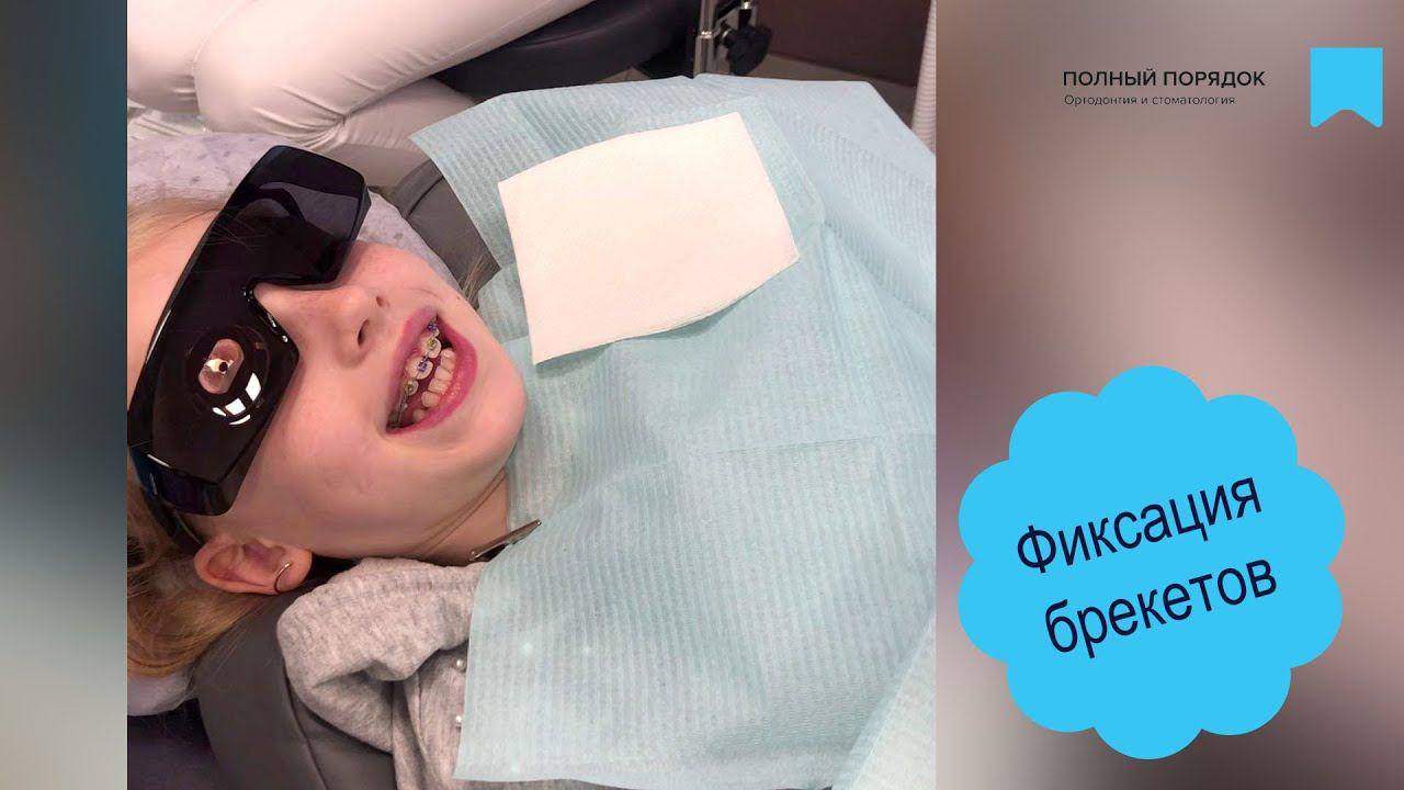 - И дуга тоже ровная будет? - вопросы на фиксации брекетов