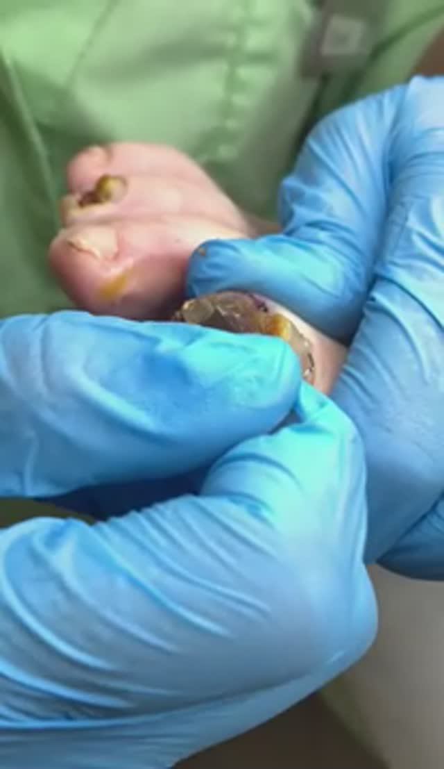 Бородавки на пальцах, удаление. Бородавка лечение. Подолог Симферополь