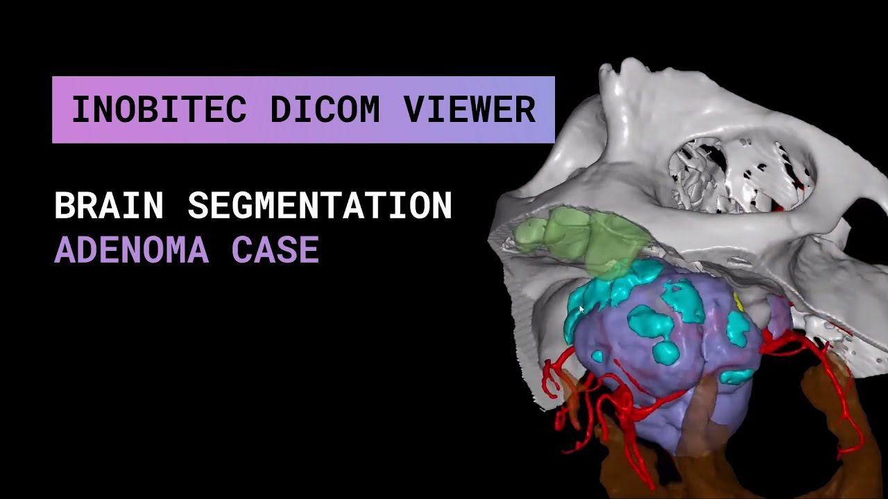 Сегментация головного мозга в Inobitec DICOM Viewer Pro на примере аденомы