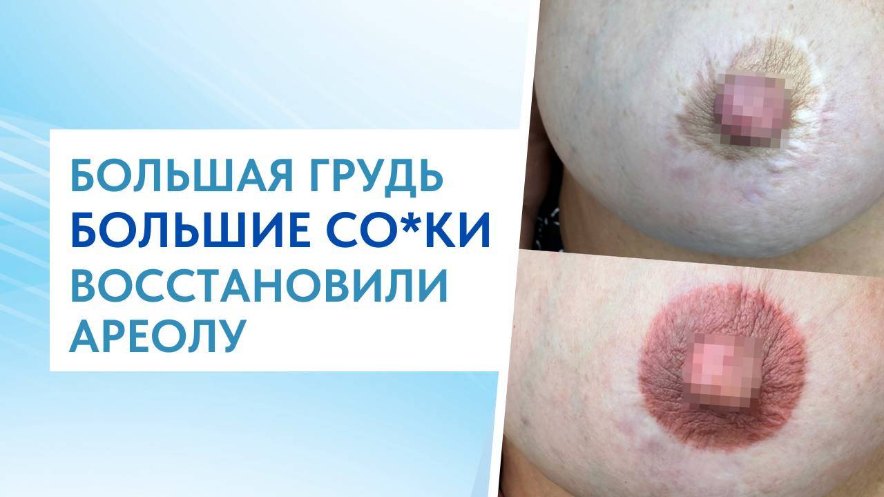 БОЛЬШАЯ ГРУДЬ, БОЛЬШИЕ СОСКИ | ВОССТАНОВИЛИ АРЕОЛУ
