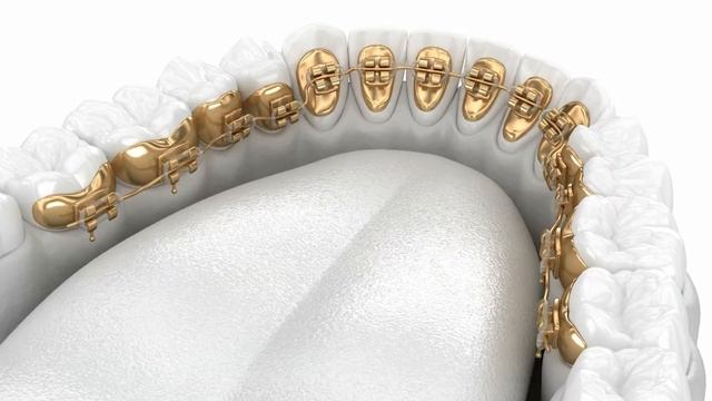 Лингвальные брекеты