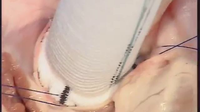 Aortic Root Replacement with Coronary Buttons