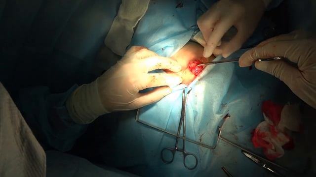 Удаление фиброаденомы молочной железы в Уфе