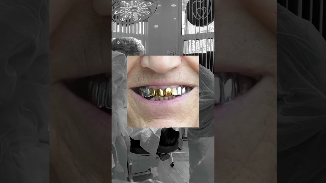 Все зубы за 1 день по методике «Все-на-4» всего от 99.000₽ в центрах «Наша стоматология» СПб