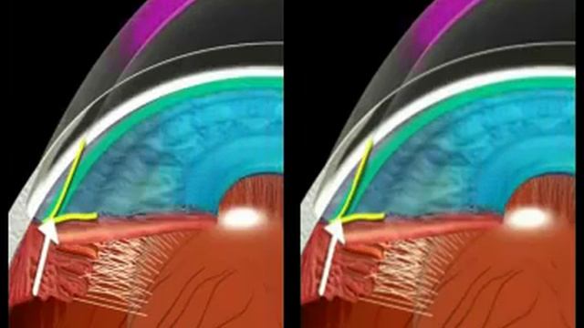 Глаукома открытоугольная