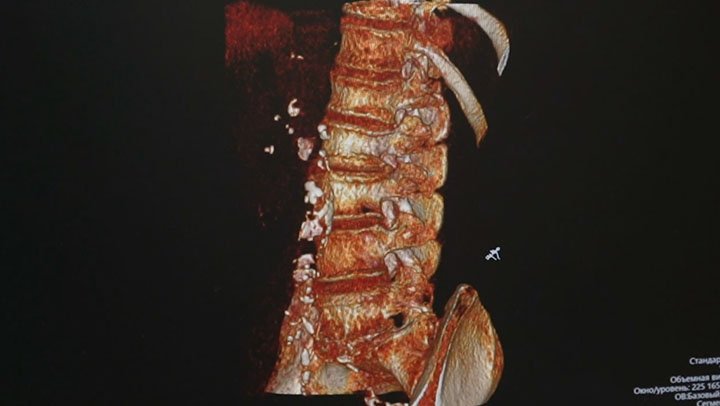 Медтайм | Боли в спине. Причины, профилактика, обследования на МСКТ.