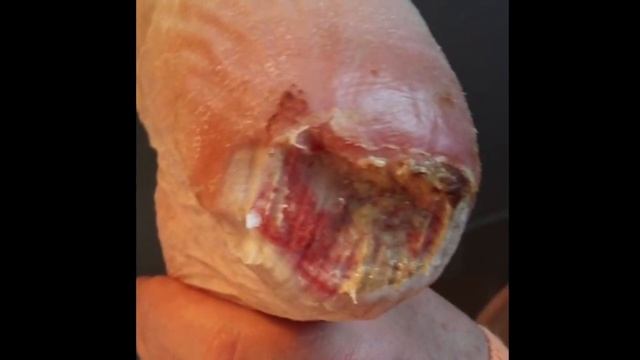 ?️ Лечение пролежней  Отзыв 2. Врач хирург Гармаев Александр Шагжиевич.mp4