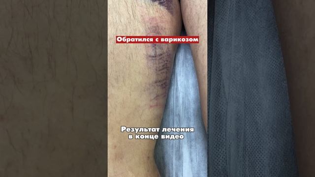 Как вам результат? ? пишине в комментариях 
#флеболог #варикоз #флебологармавир #здоровье #флеболог
