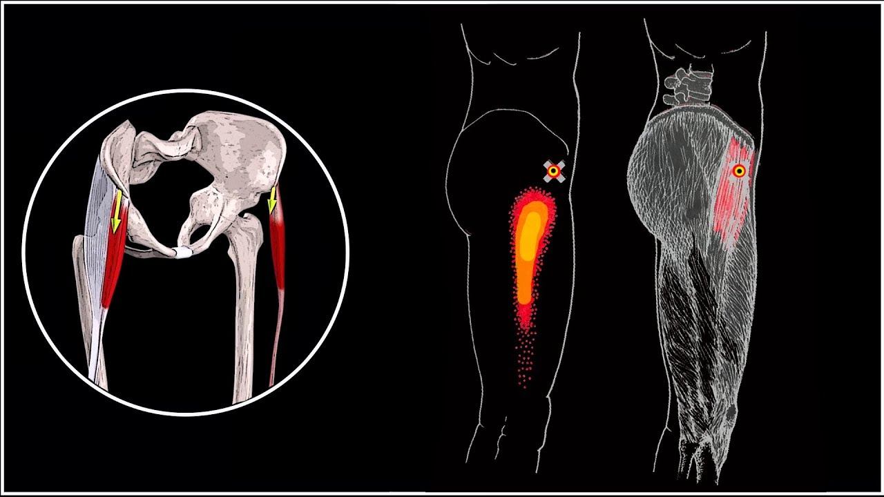 БОЛИТ БОКОВАЯ ПОВЕРХНОСТЬ БЕДРА И ТАЗОБЕДРЕННЫЙ СУСТАВ  НАПРЯГАТЕЛЬ ШИРОКОЙ ФАСЦИИ БЕДРА