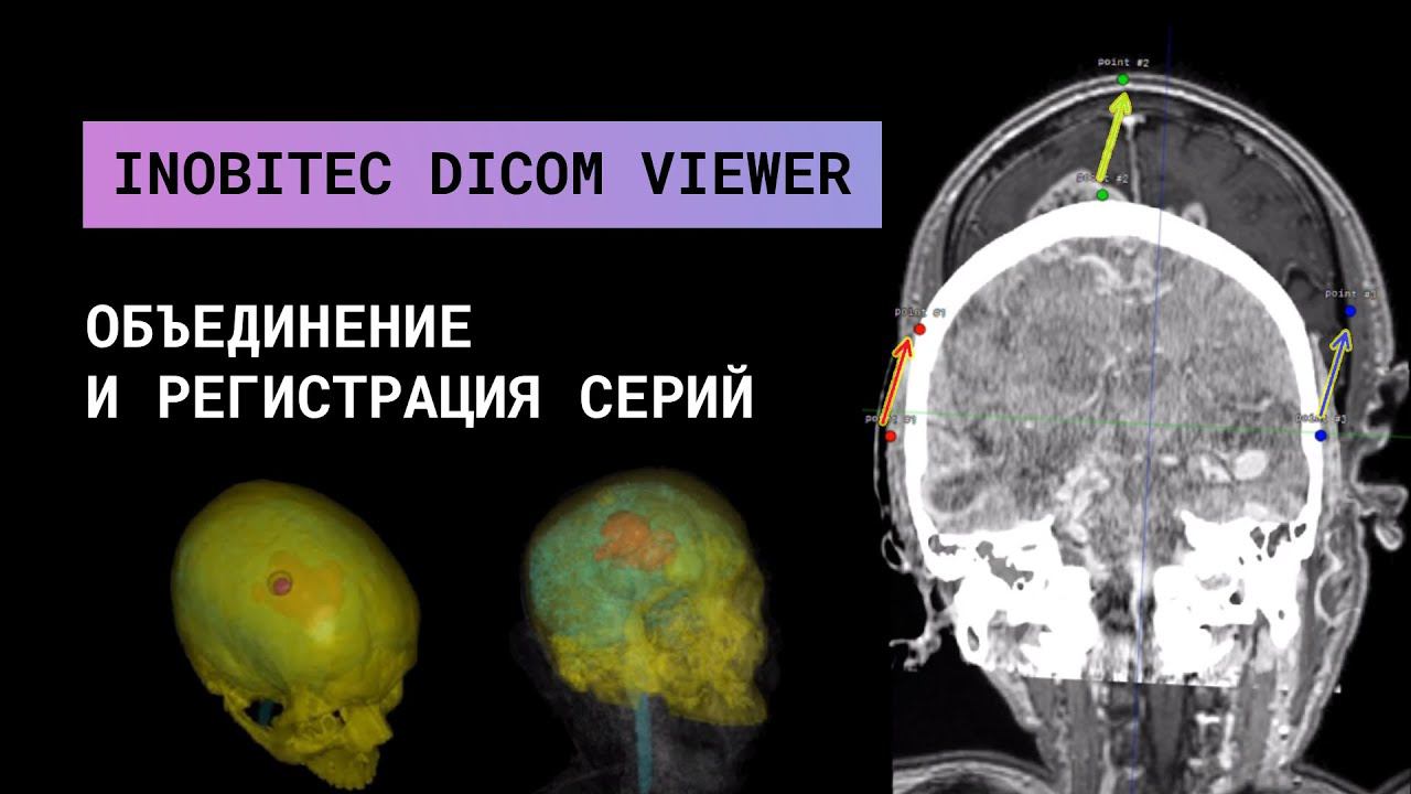 Объединение и регистрация серий в Инобитек DICOM-Просмотрщике