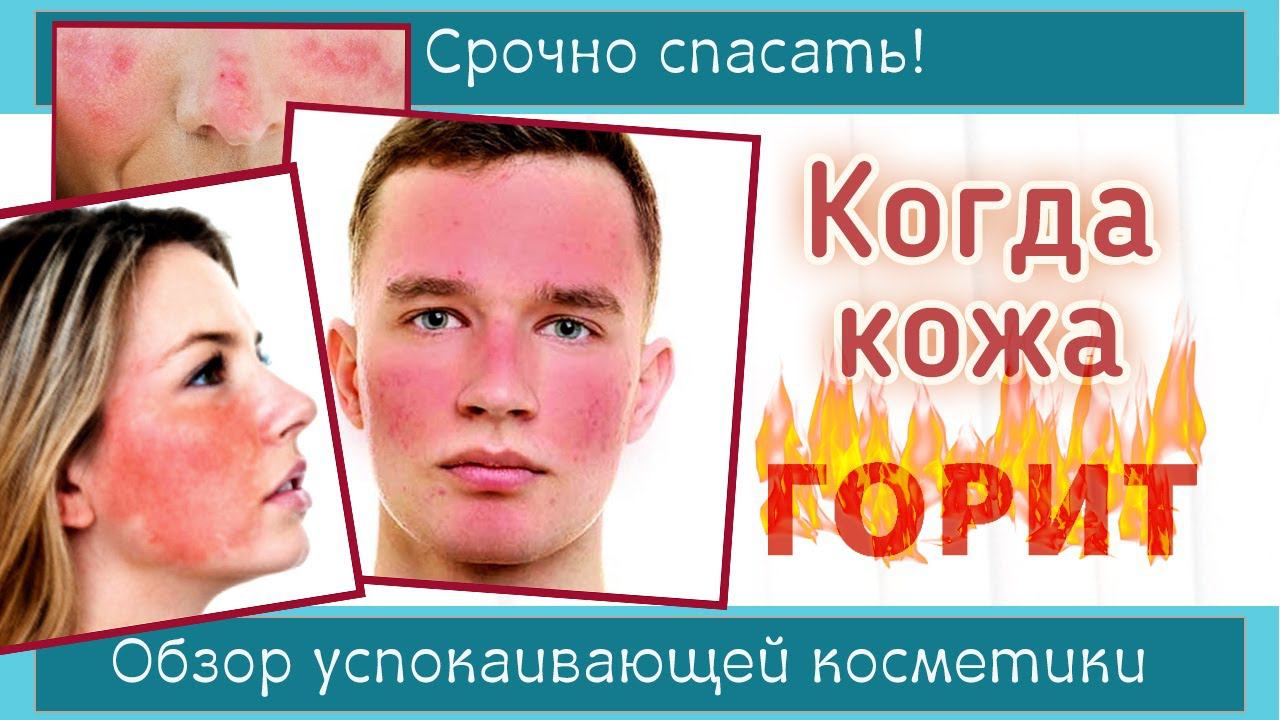 SOS-УХОД для ПРОБЛЕМНОЙ КОЖИ | Покраснение лица - как помочь