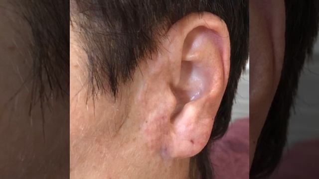 КОНТУРНАЯ ПЛАСТИКА КОРРЕКЦИЯ УШНОЙ РАКОВИНЫ Сеть клиник косметологии GEN87