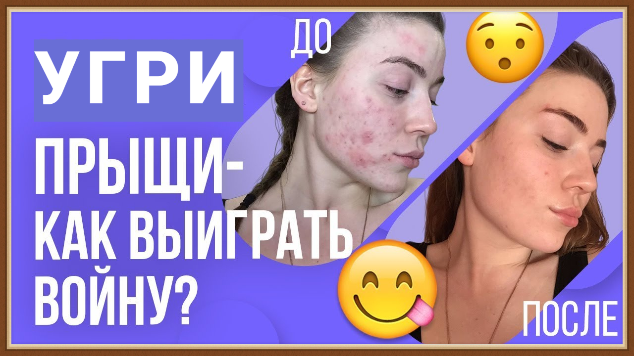 УГРИ НА ЛИЦЕ - ЧТО ДЕЛАТЬ