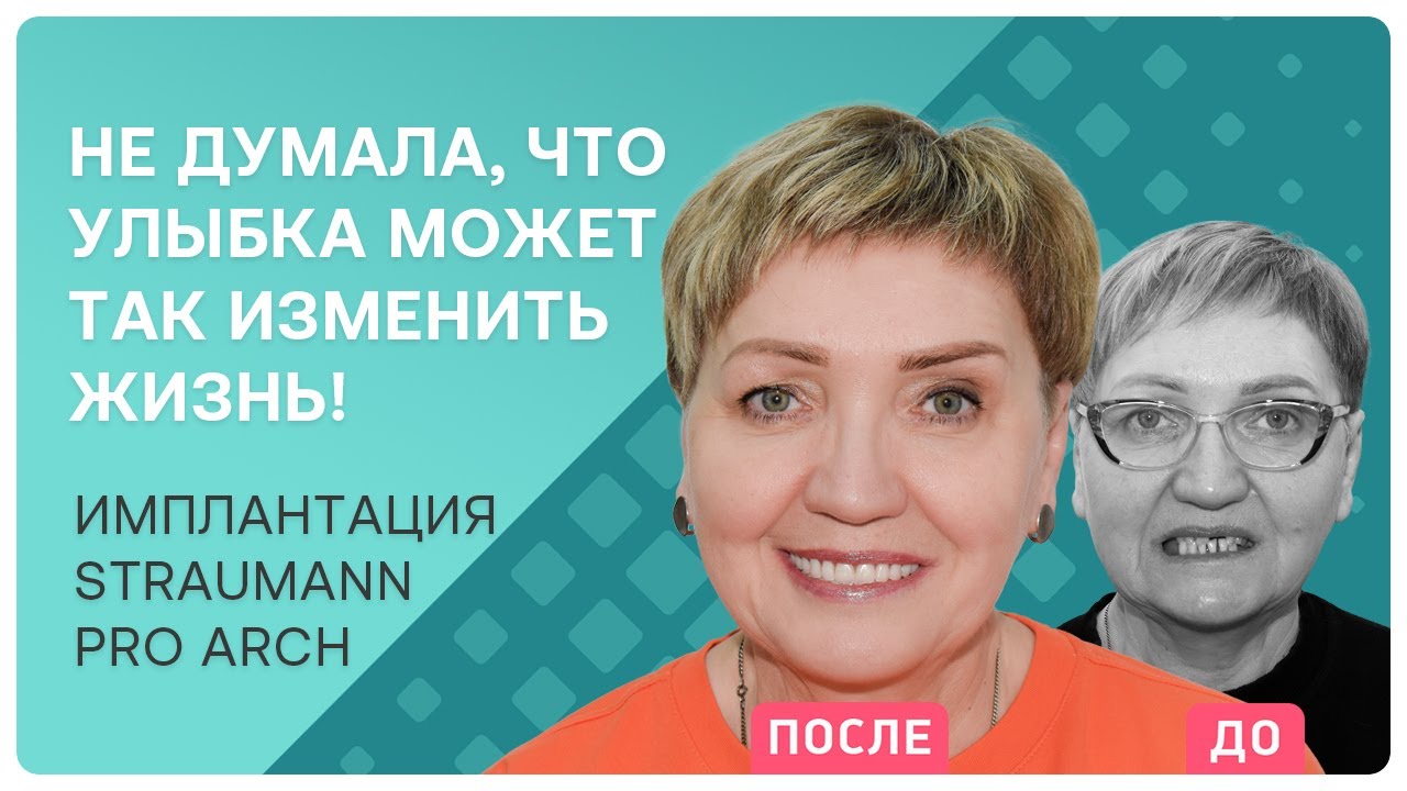 Все зубы на 4 имплантах Straumann: этапы имплантации