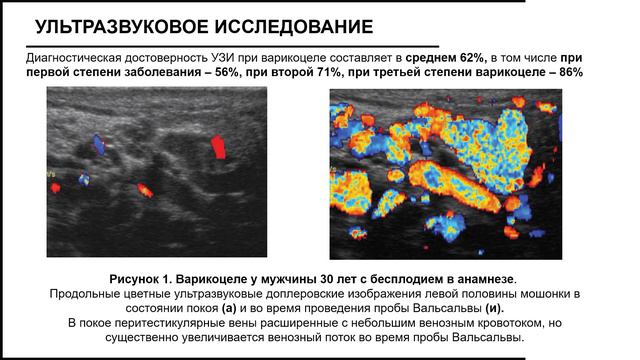 №6. Варикоцеле
