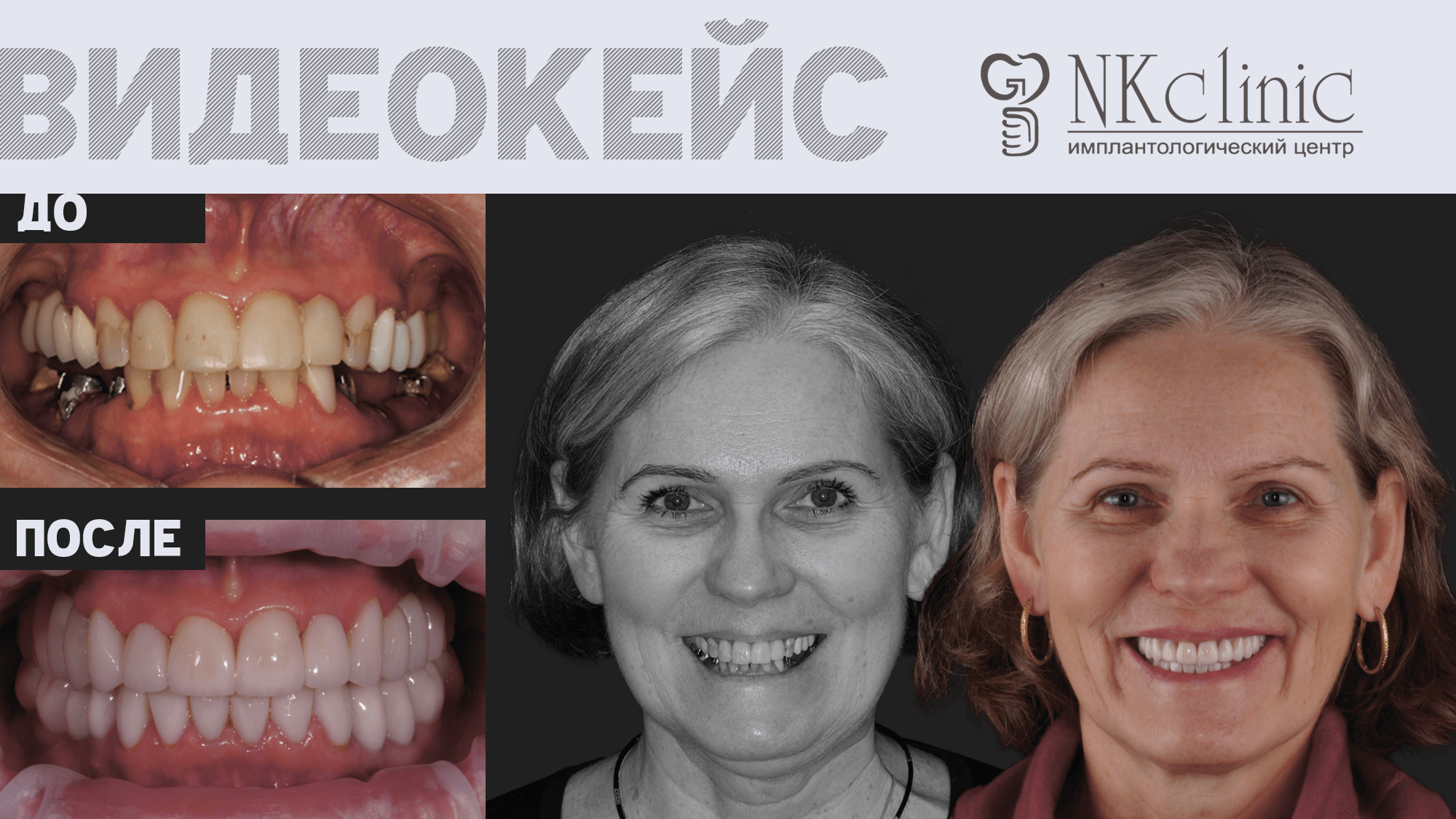 Тотальная имплантация и выравнивание на брекет-системе