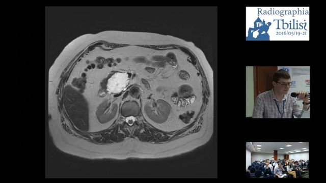 МР-диффузия. Молекулярная визуализация в онкологии