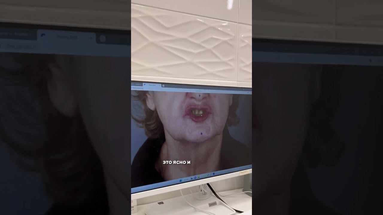 Зубы за 1 день: имплантация и протезирование по методике «Всё-на-4». В аккаунте много полезного