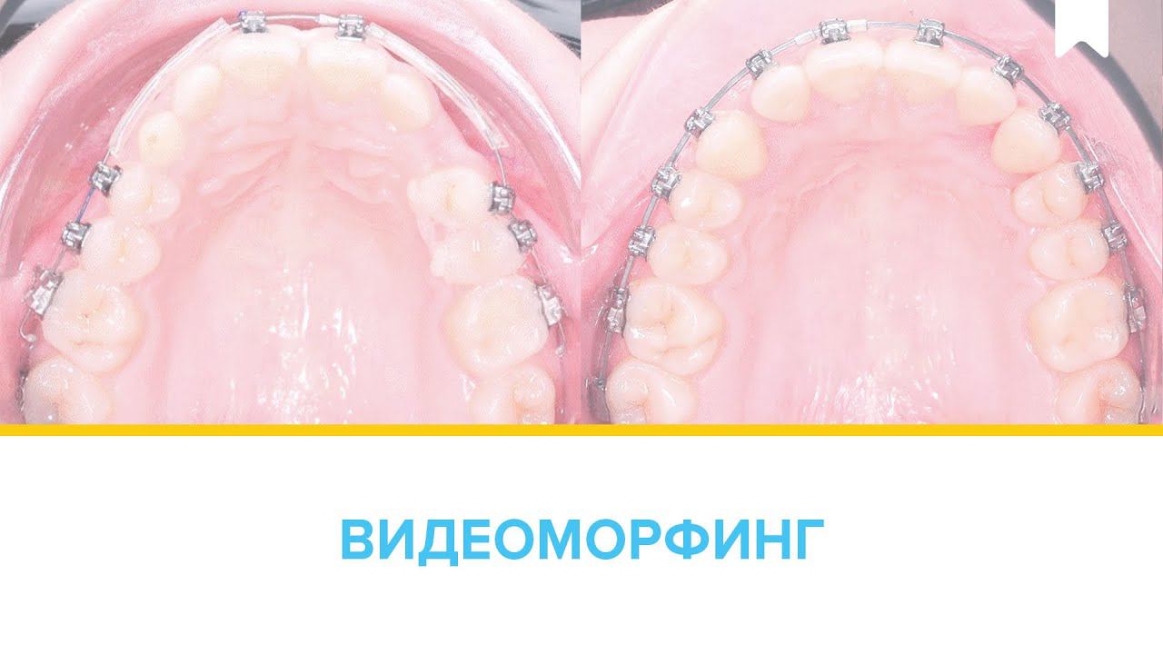Ортодонтичеcкое лечение двухсторонней ретенции клыков на ВЧ брекетами Damon Q