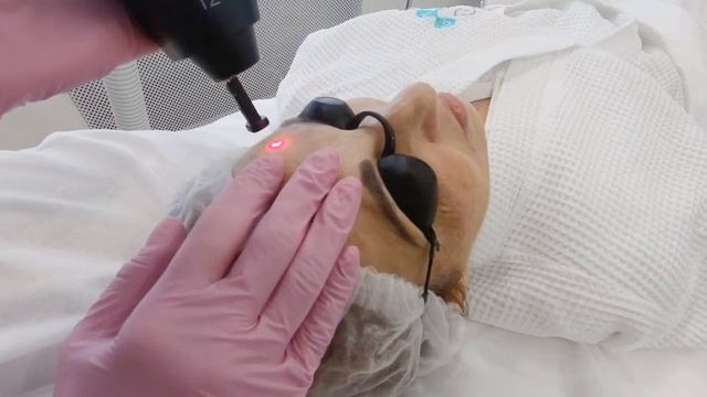 ГЛУБОКАЯ ЛАЗЕРНАЯ ШЛИФОВКА NANO PIXEL CO₂ Сеть клиник косметологии GEN87