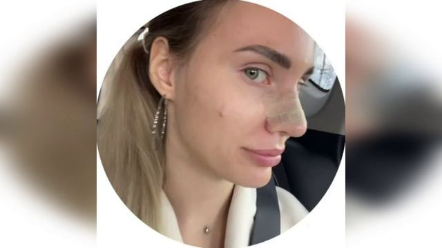 2 день после закрытой риносептопластики с коррекцией кончика носа