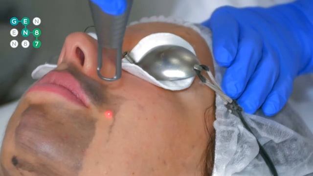 КАРБОНОВЫЙ ПИЛИНГ И НЕОДИМОВОЕ ОМОЛОЖЕНИЕ Сеть клиник косметологии GEN87